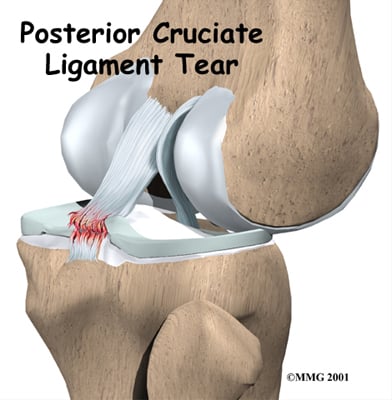 PCL Tear Treatment in Coimbatore | Advanced PCL Tear Hospital in Coimbatore