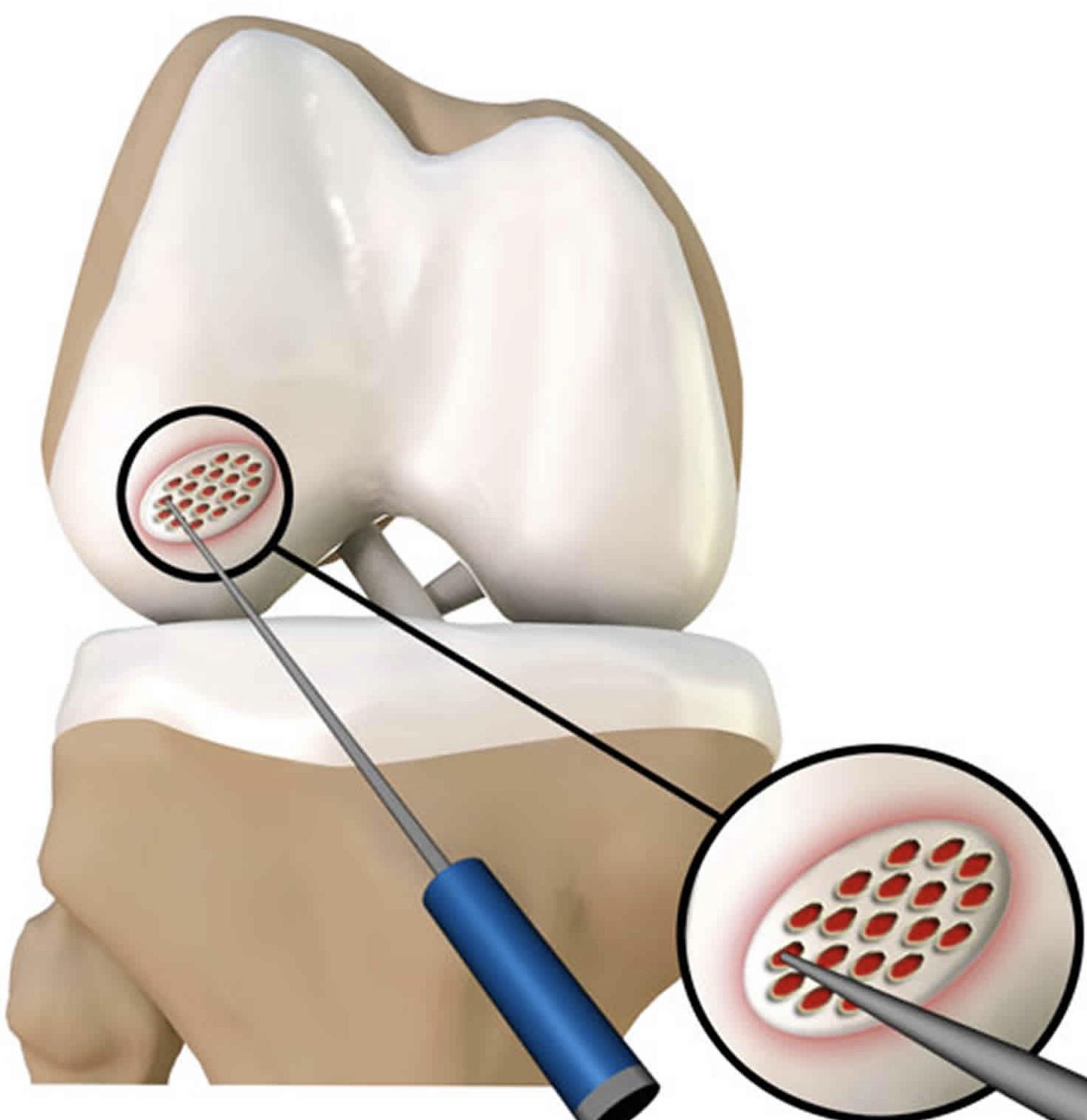 Articular Cartilage Injury Treatment in Coimbatore | Best Articular ...