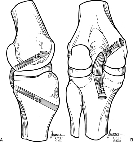 PCL Tear Treatment in Coimbatore | Advanced PCL Tear Hospital in Coimbatore