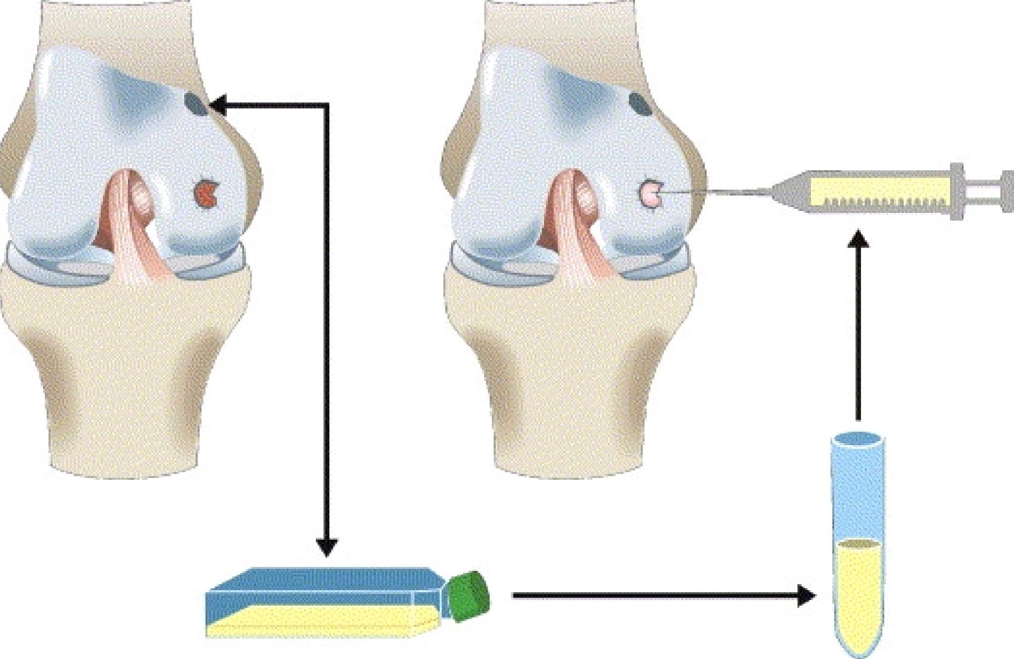 Articular Cartilage Injury Treatment in Coimbatore | Best Articular ...