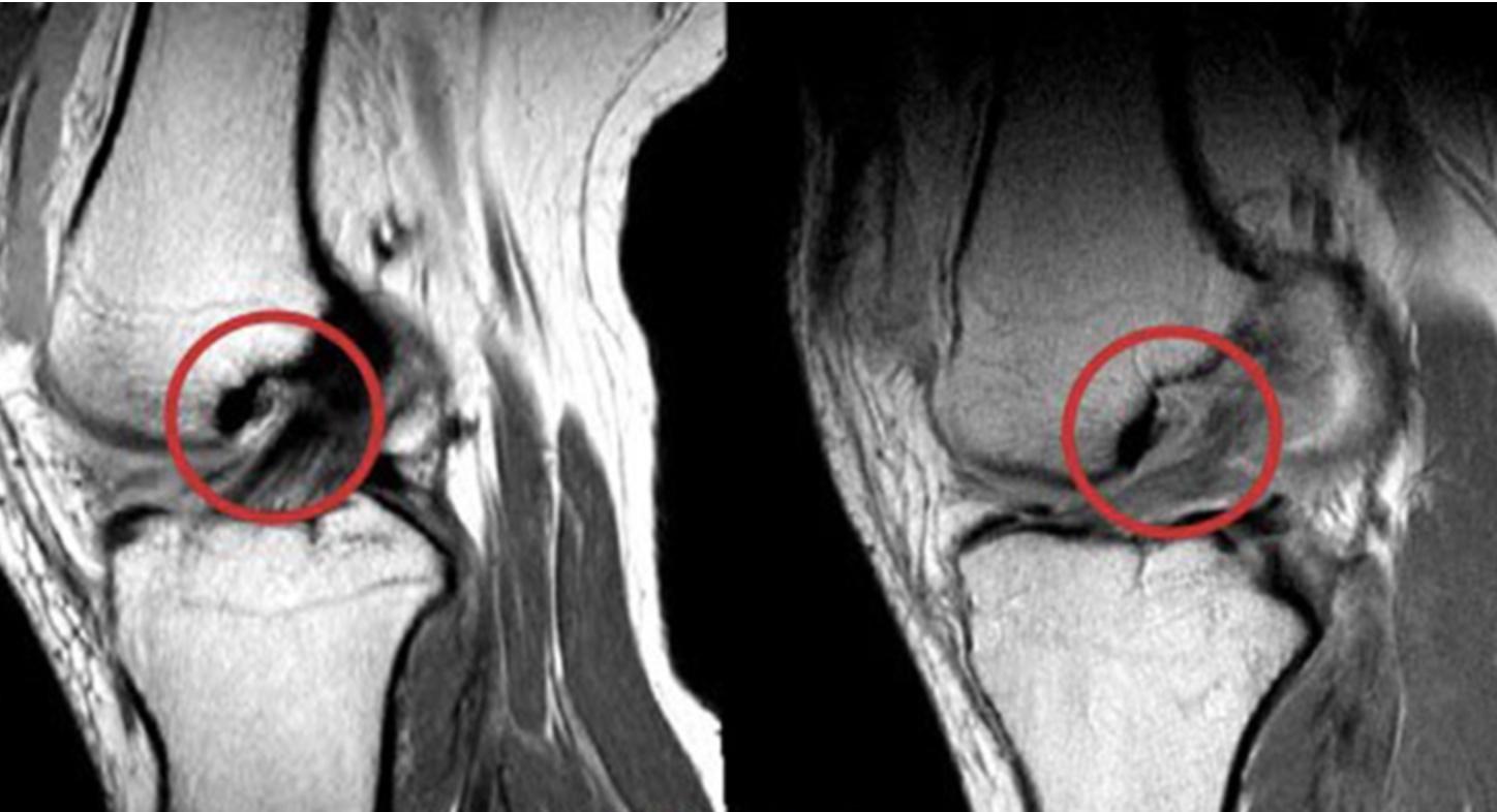 ACL Tear Surgery in Coimbatore | Ganga Hospital Knee Specialists
