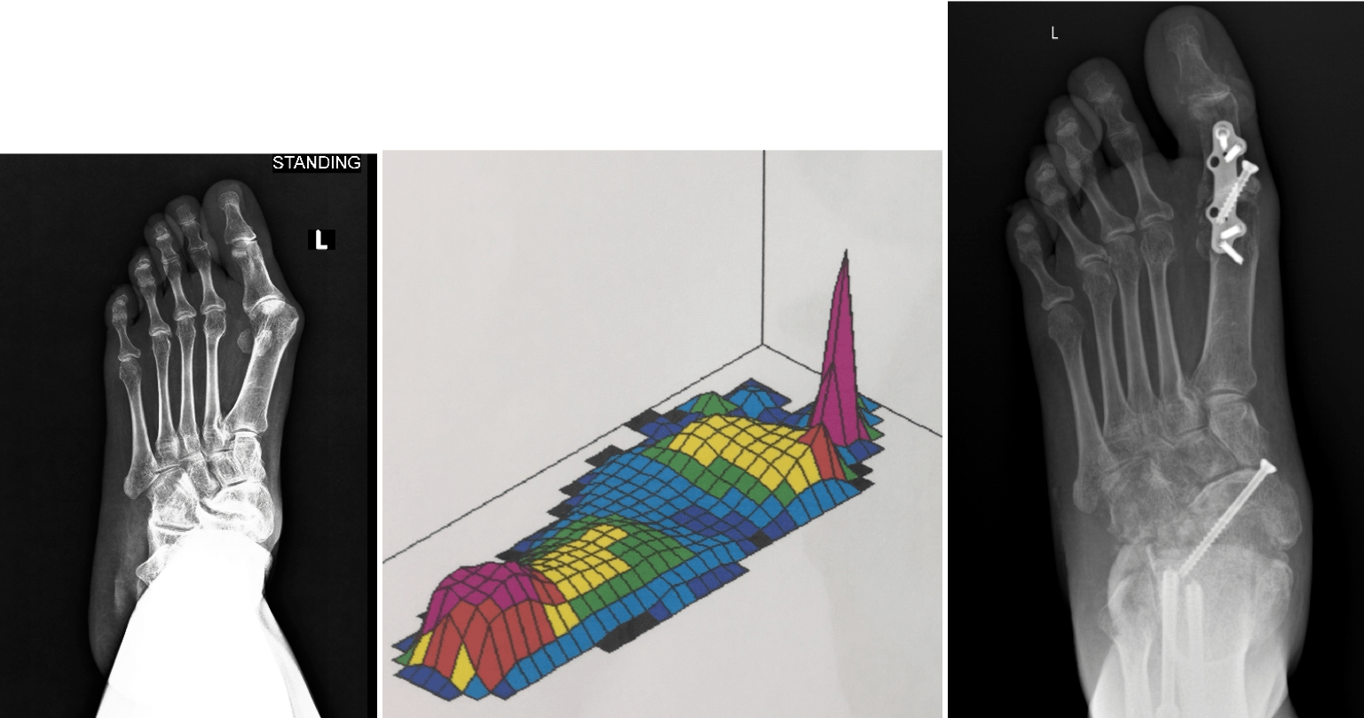 Best Hallux Valgus Surgery in Coimbatore | Hallux Valgus Surgery ...