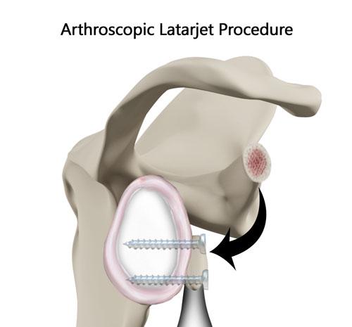 Recurrent Shoulder Dislocation Treatment in Coimbatore | Ganga Hospital ...