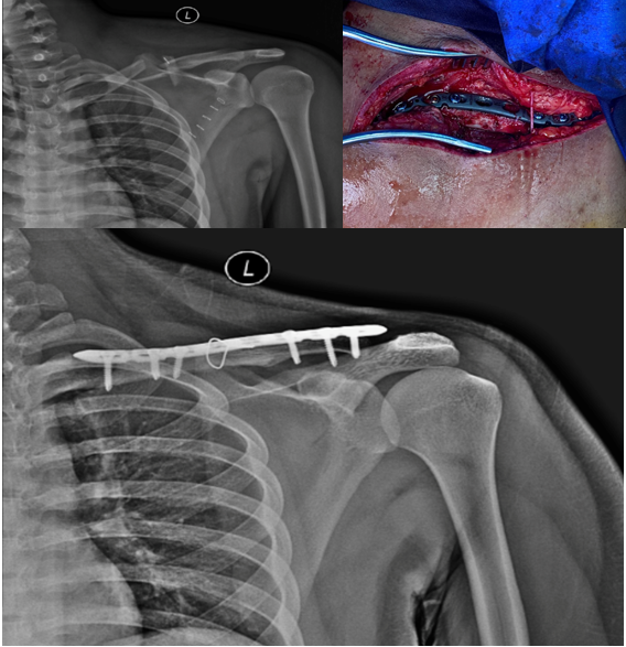 Clavicle Fracture Treatment in Coimbatore | Best Clavicle Fracture ...